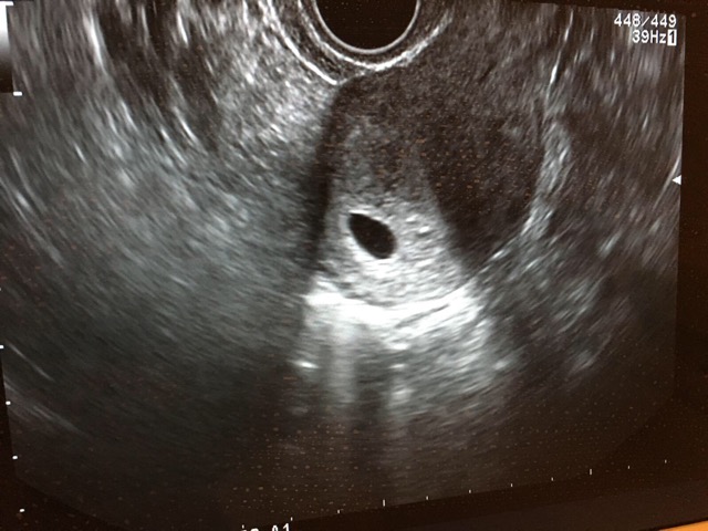 5 Week Ultrasound Pictures