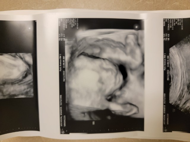 Twin Boys Anatomy Scan 💙💙 - Glow Community