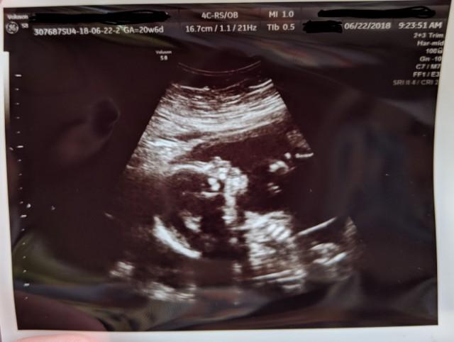 21 week Anatomy Scan - Glow Community