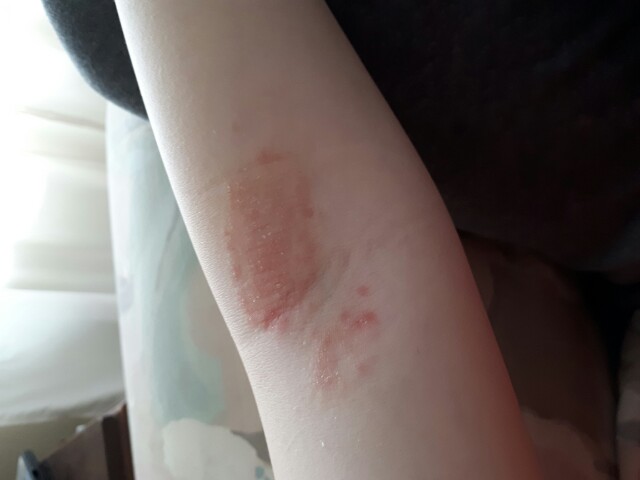 weird rash on arm?? - Glow Community