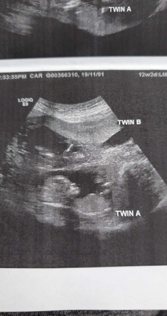 12 week Twins Ultrasound! - Glow Community