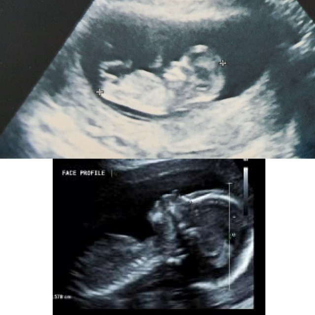12 weeks above & 18 weeks scan below. Anyone can tell the gender ...