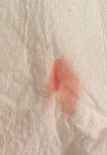 Transvaginal scan caused me to bleed all day is this abnormal bleeding ...