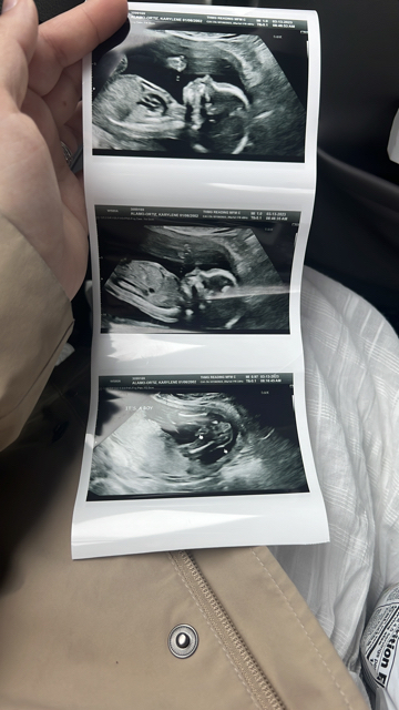 20 week anatomy scan - Glow Community