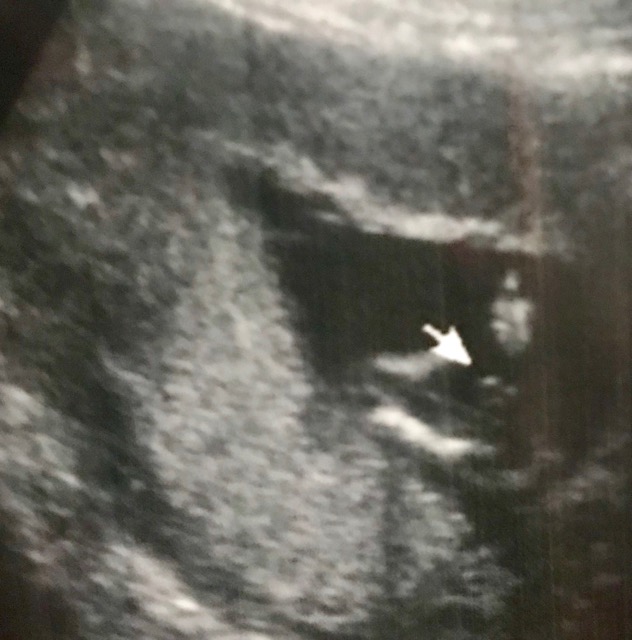 13 Week Gender Scan - Glow Community