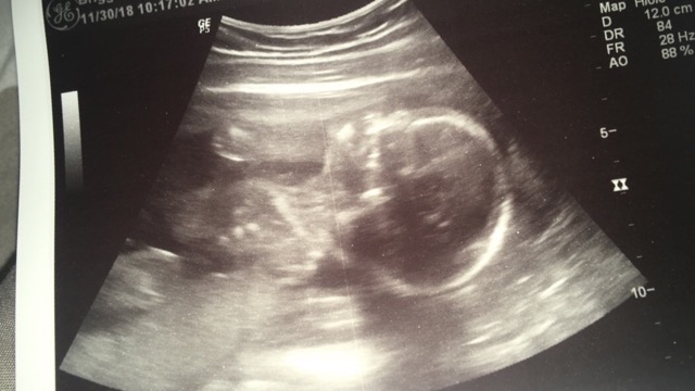 21 week anatomy scan - Glow Community