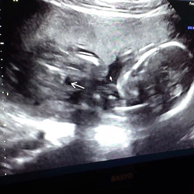 21 week anatomy scan - Glow Community