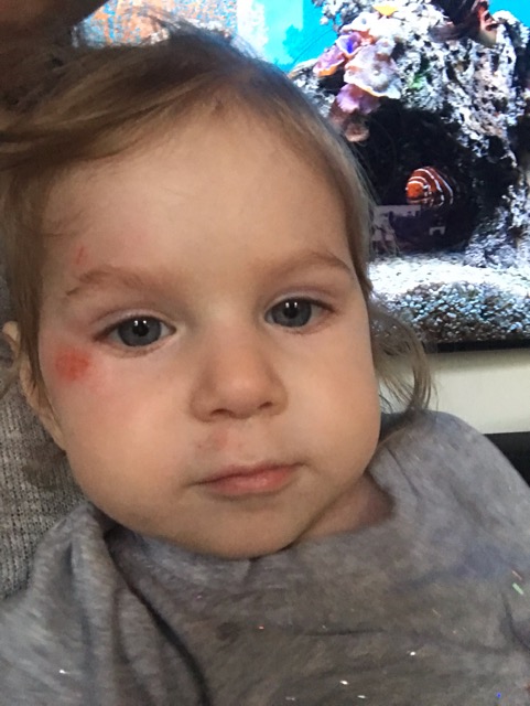 Scraped face treatments? - Glow Community