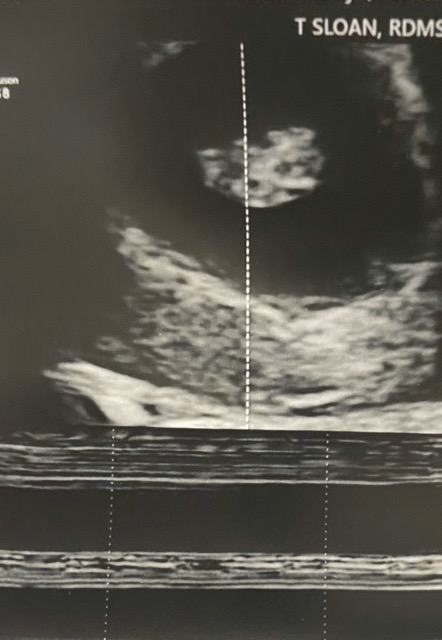 7 weeks 6 days. Ultrasound look normal? - Glow Community