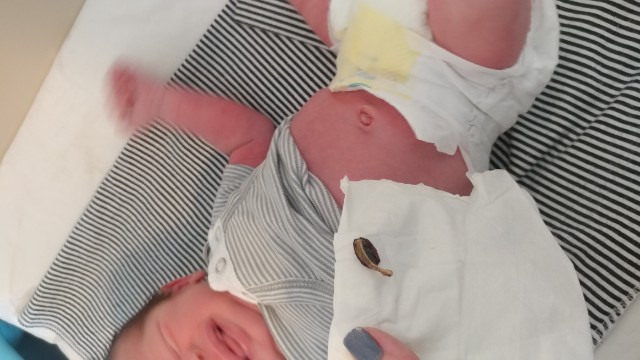 Infected baby belly button or not? - Glow Community