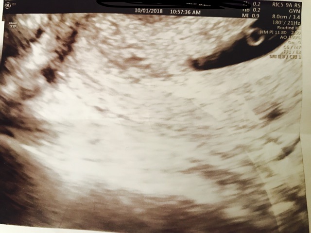 Does my ultrasound look weird because of tilted uterus - Glow Community