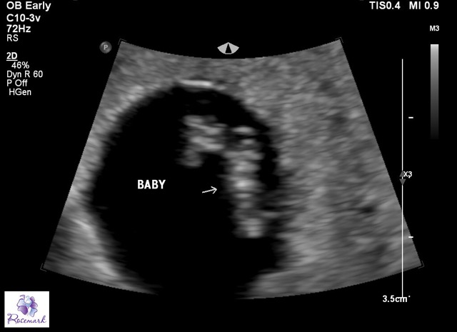 Ultrasound at 6w5d. Transvaginal- boy or girl Ramzi guesses? - Glow Community