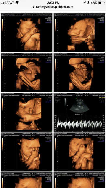 3D Ultrasound (32 weeks with Ava Skye) - Glow Community