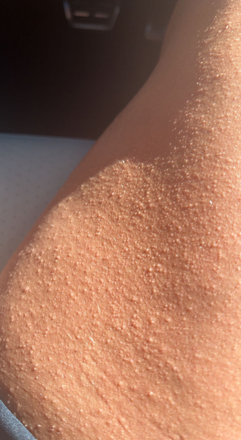 Rash all over body after beach - Glow Community