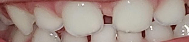 Translucent edges of teeth - Glow Community