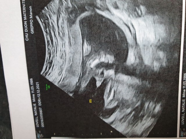 18 week scan, having a baby boy 🥰 - Glow Community