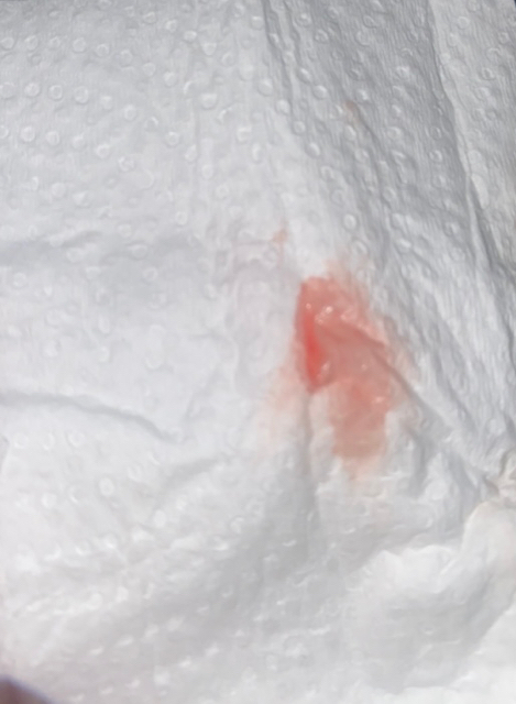 Transvaginal scan caused me to bleed all day is this abnormal bleeding ...