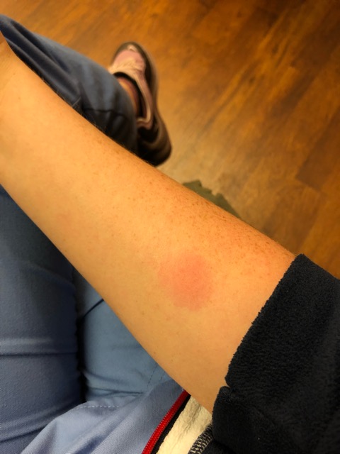 Does This Look Like A Positive TB Test It Does Feel Like A Lump Is 