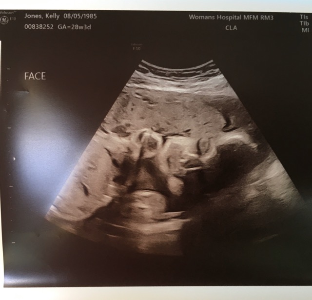 28 week ultrasound baby measuring ahead - Glow Community
