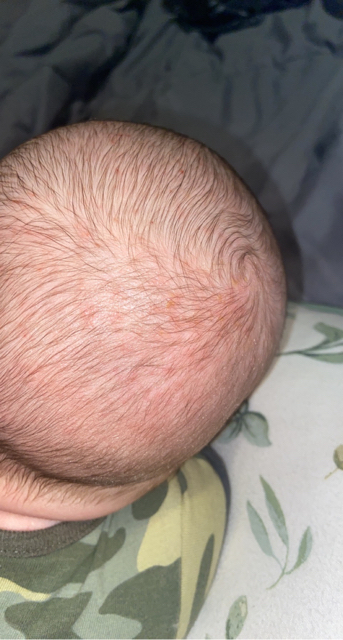 red rash on babies head? - Glow Community