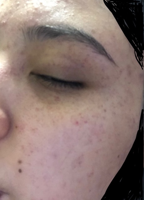 Tiny red dots in my face especially around eyes - Glow Community