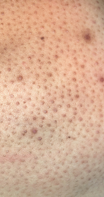 what are these bumps all over my body - Glow Community