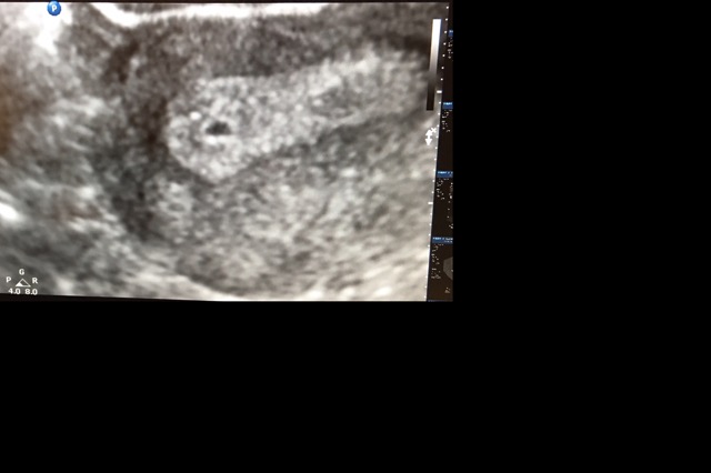 Normal 4 week ultrasound? - Glow Community