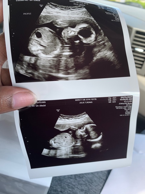 20 week anatomy scan - Glow Community