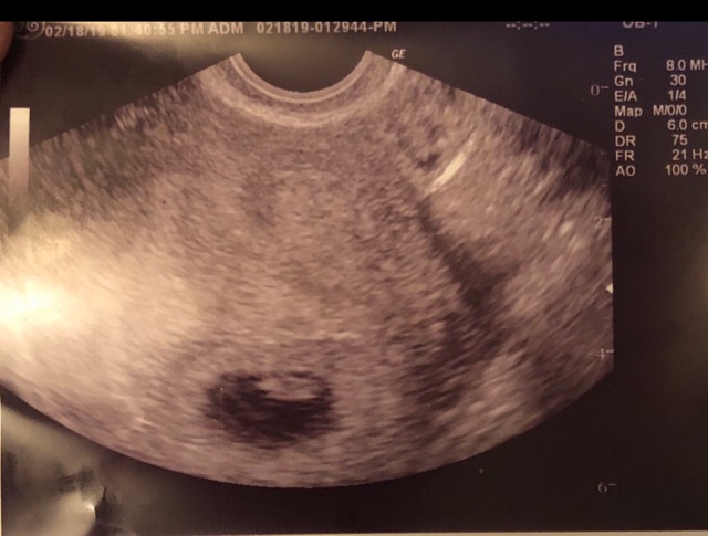 6 weeks 6 Days Pregnant- Transvaginal Ultrasound Scan- Early Gender ...