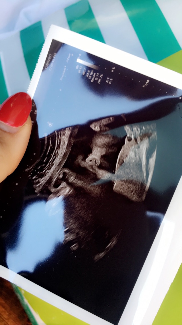 35 weeks scan - normal side slice of nose?!! lol - Glow Community