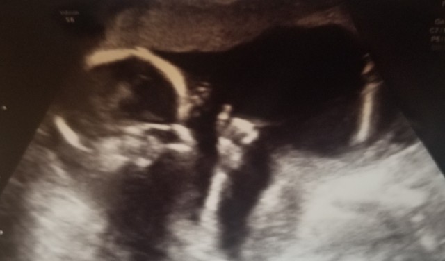 19 weeks Anatomy Scan! - Glow Community