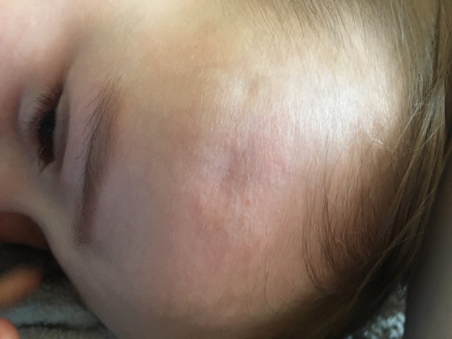 Dent on head after fall - Glow Community