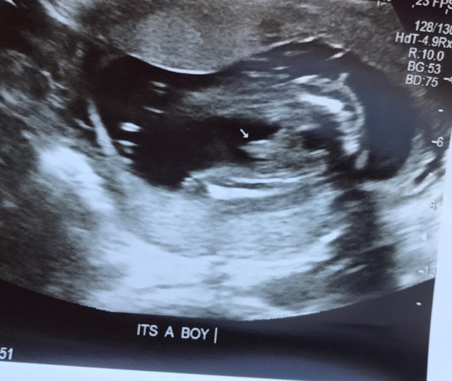 Sneak Peek was right at 19 week anatomy scan... - Glow Community