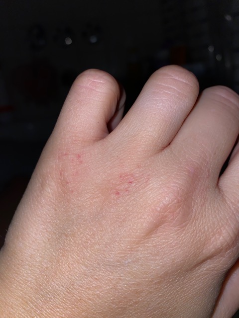 Weird rash on hands - Glow Community