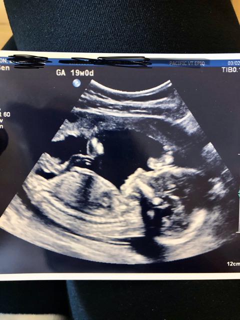 19 weeks and anatomy scan - Glow Community