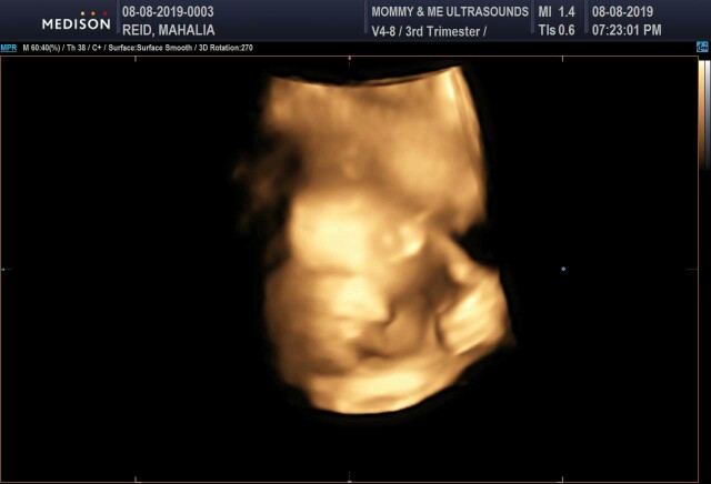 Baby bumps, my B belly, Also pictures of my ultrasounds - Glow Community