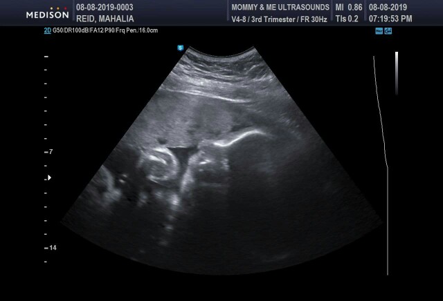 Baby bumps, my B belly, Also pictures of my ultrasounds - Glow Community