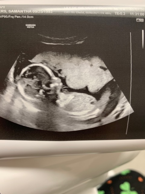 19 weeks 5 days Anatomy scan - Glow Community