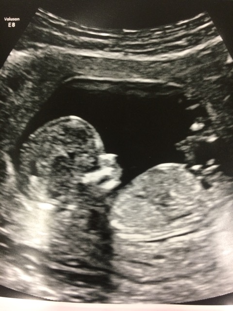 13 week ultrasound. Nub theory?? Due March 5th 💕🌈👶 - Glow Community