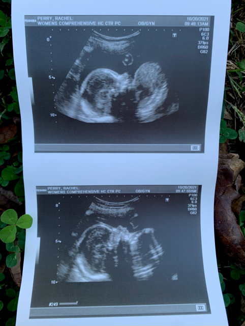 Had our anatomy scan done today; currently 22 weeks with our girl💕😍 ...