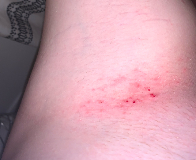 TMI! Bikini line razor burn/bumps/rash - Glow Community