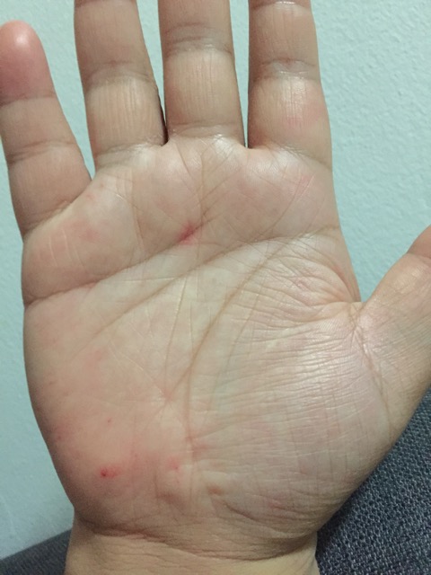 Red spots on palm-Is it related to pregnancy? - Glow Community