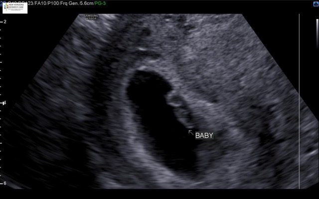 6 weeks 4 days vaginal ultrasound 💙💖 heart beat 142 - Glow Community