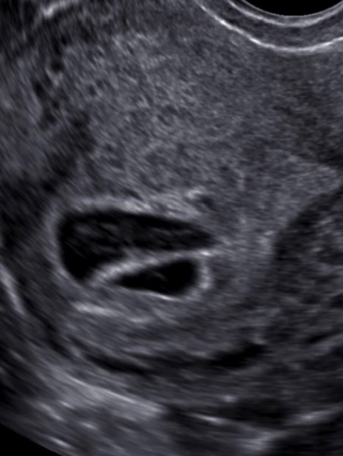 Subchorionic Hemorrhage 5 weeks - Glow Community