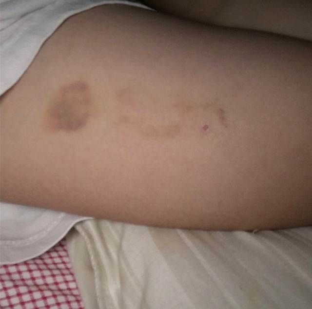 Nexplanon healing process - Glow Community