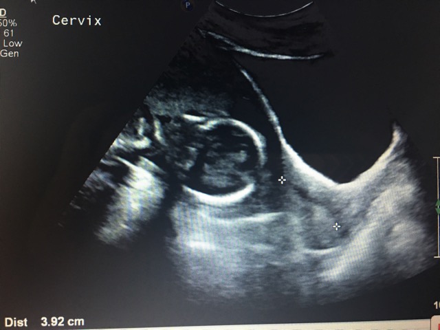 20 week ultrasound- cervix - Glow Community