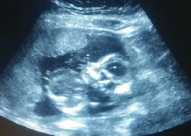 Baby bumps, my B belly, Also pictures of my ultrasounds - Glow Community