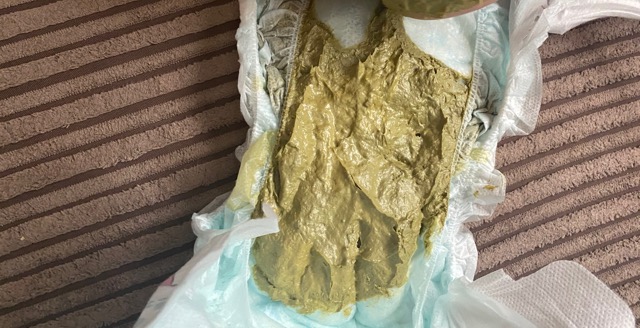 TMI/ poop.... Does this look like a normal stool for a nearly 5 month ...