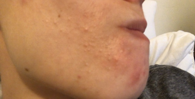 Little Bumps All Over Lower Half Of Face Glow Community little-bumps-all-over-lower-half-of-face-glow-community
