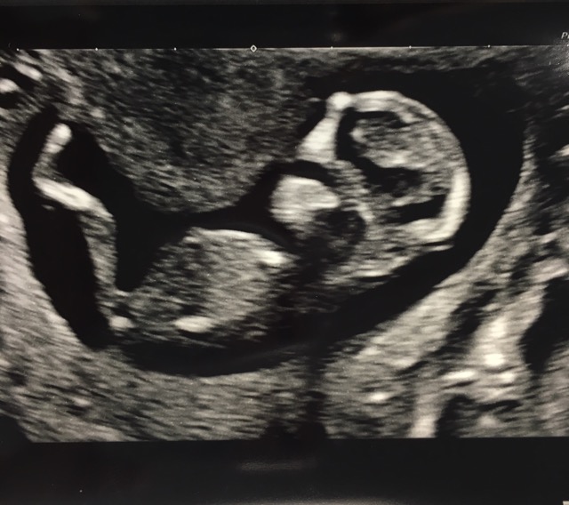 Nub Theory? 12 week abdominal scan - Glow Community